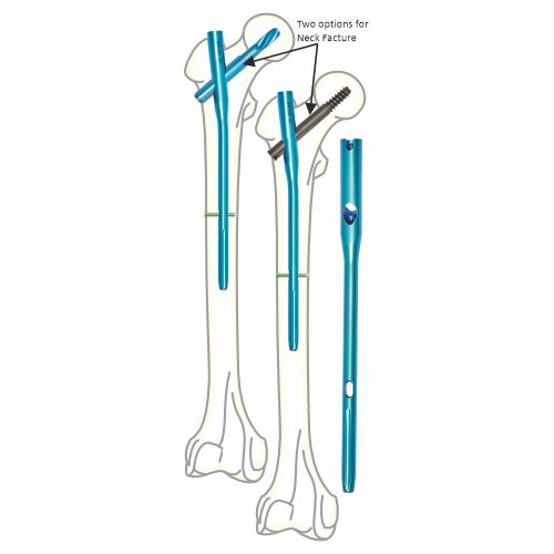 Interlocking Nails – AOSYS