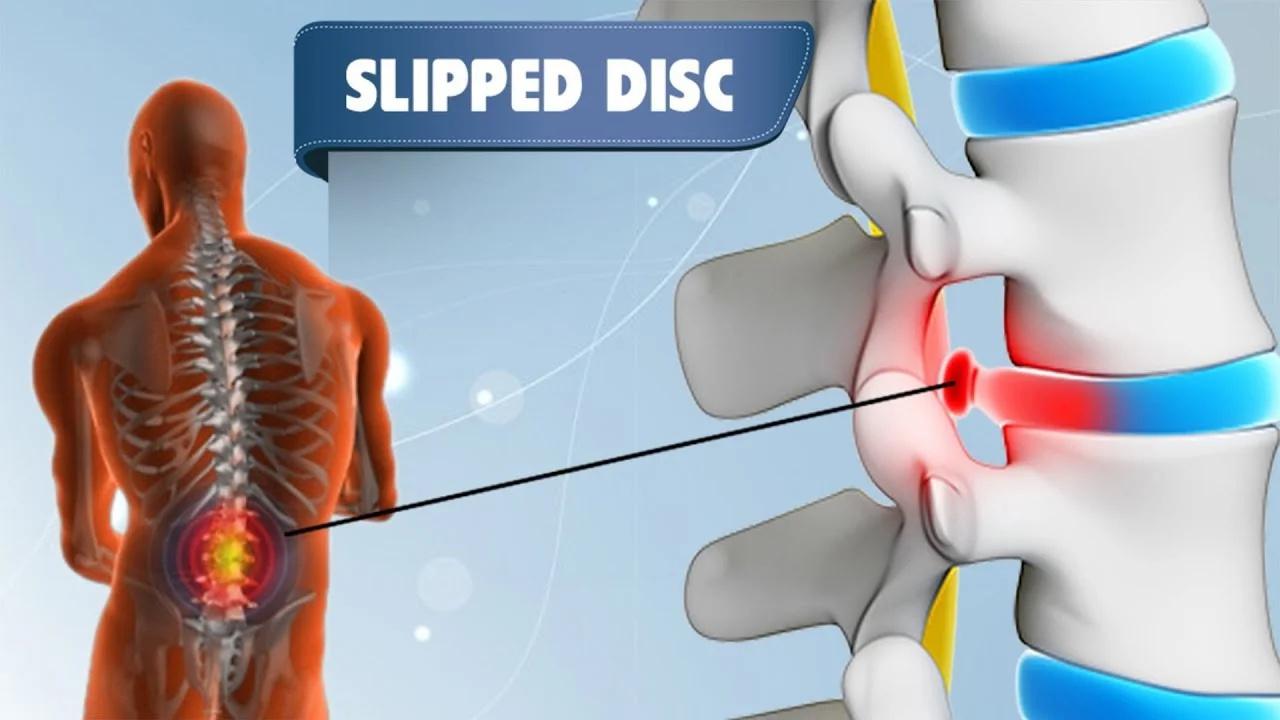 Herniated Disc: Causes, Symptoms, Types, and Treatment Guide – AOSYS
